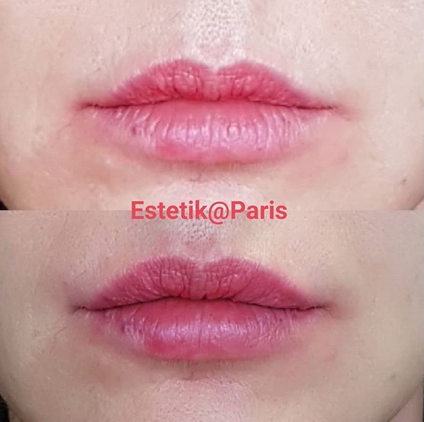 Galerie Photos : Embellissement des lèvres - Docteur Philippe Azoulay